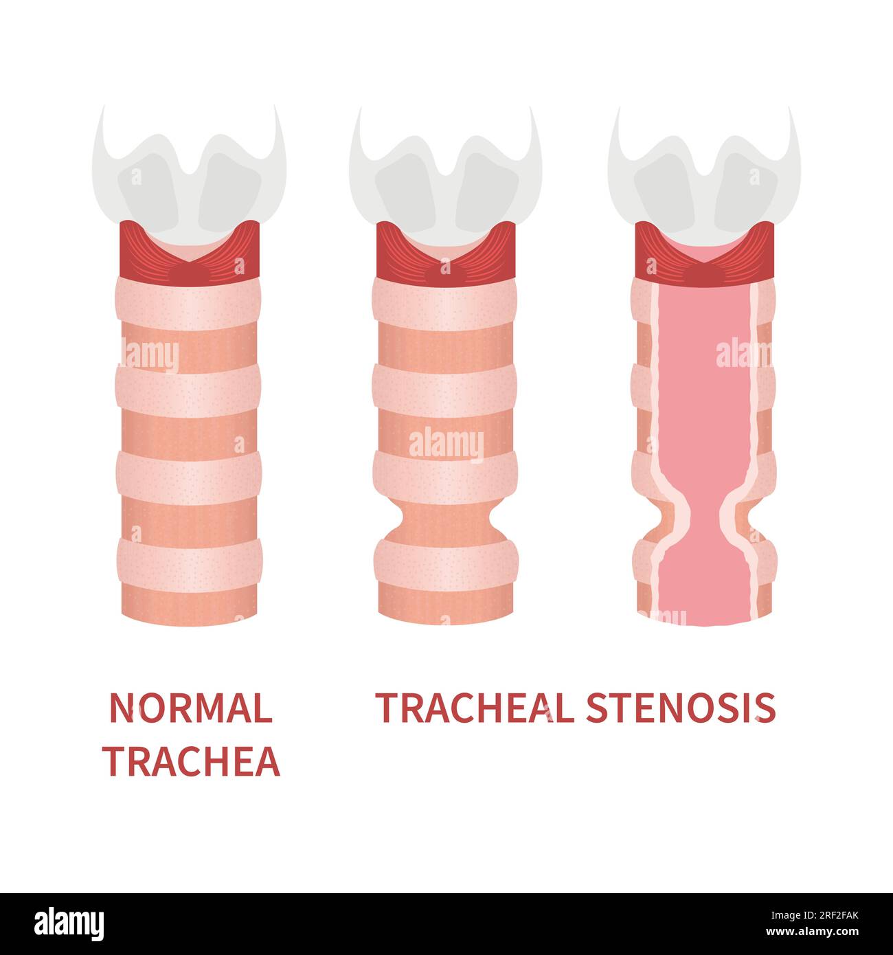 Tracheal stenosis awareness illustration. Trachea narrowing symbol ...