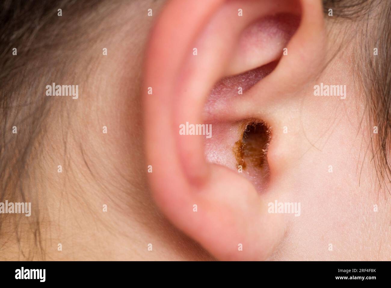 Earwax in the dirty ear of child. Hole ear of human, wax on hair and ...