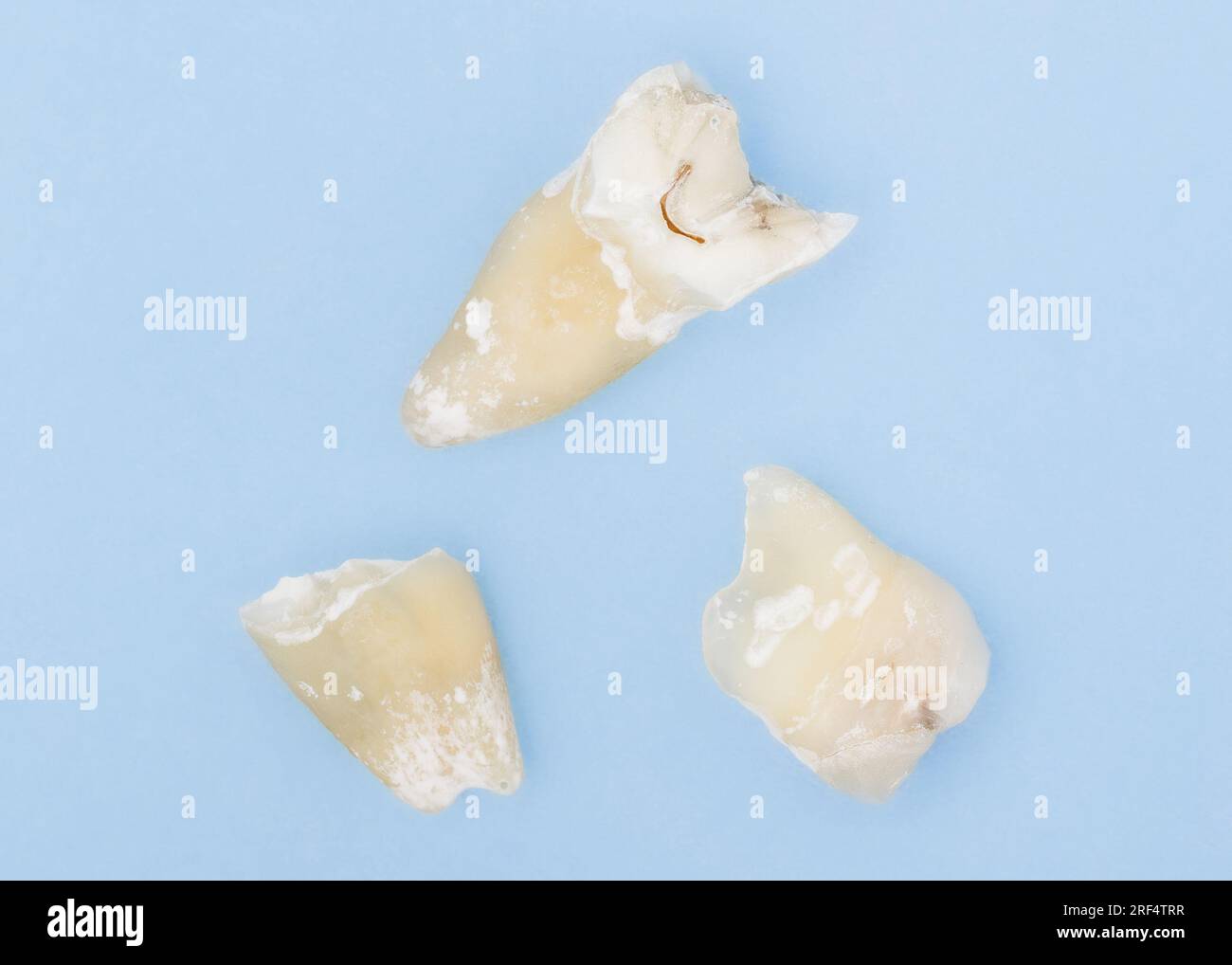 Overhead view of an extracted molar tooth in three pieces Stock Photo ...