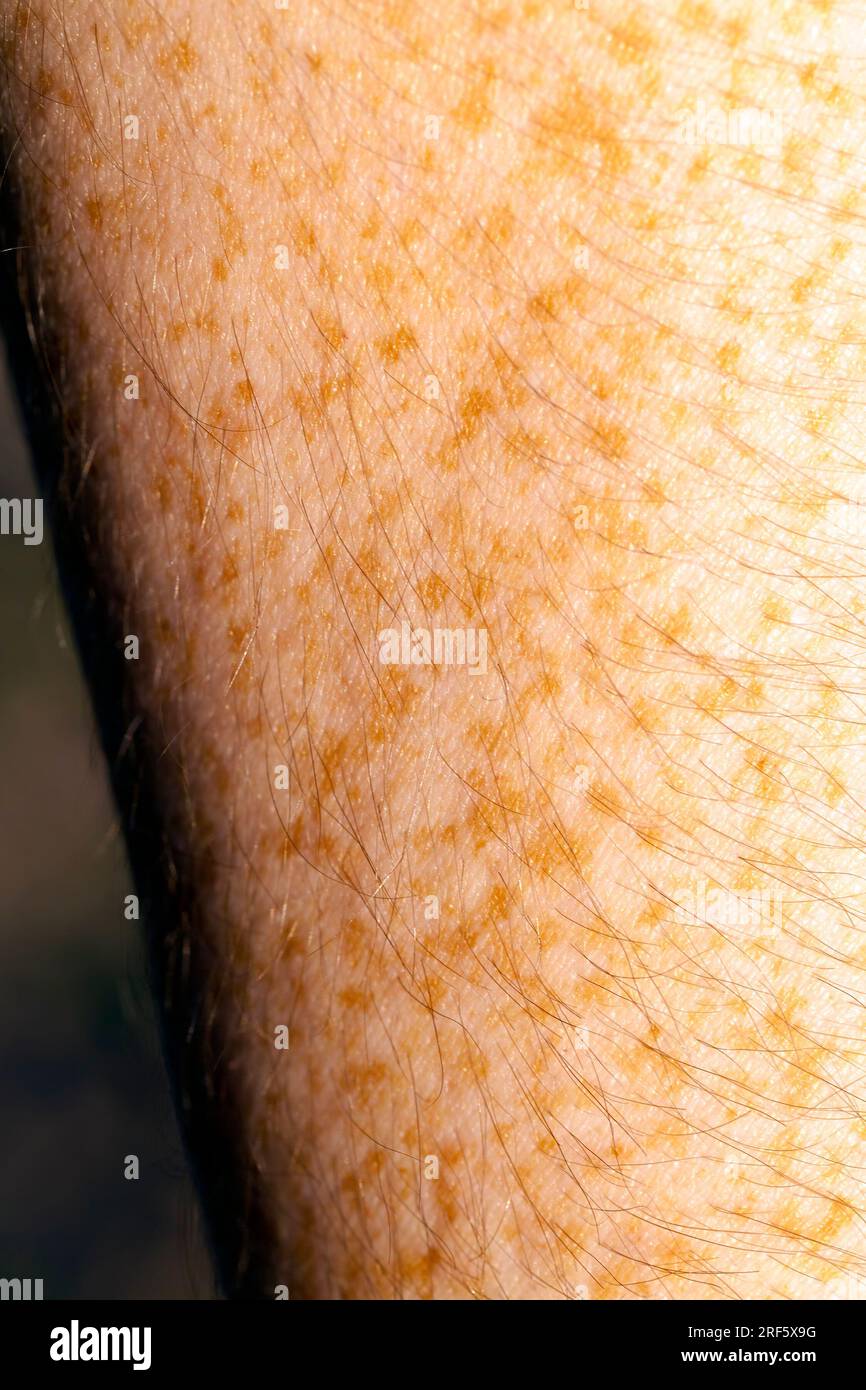 body part of the hand of a person with a large number of freckles ...
