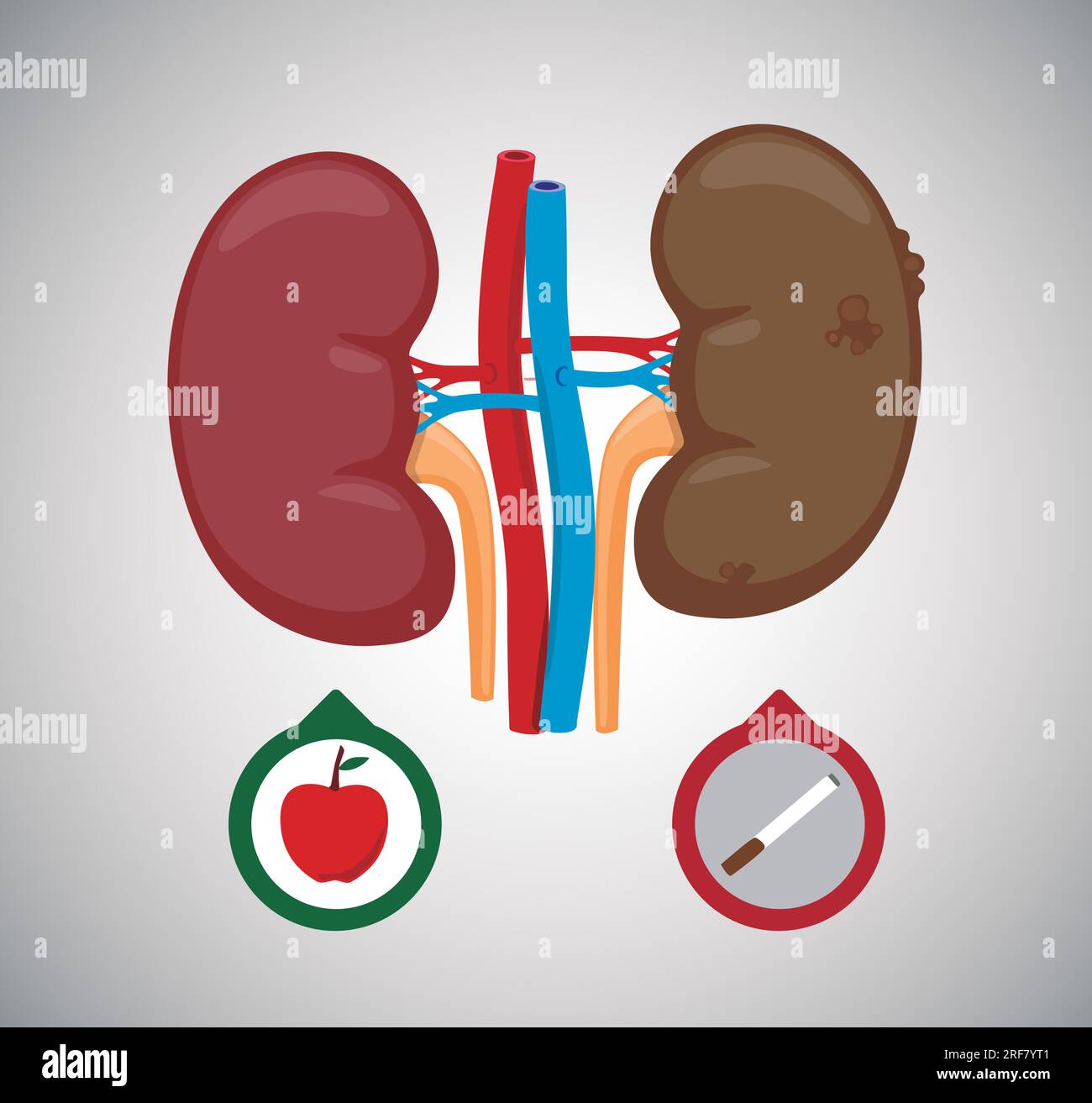 Healthy and sick kidney vector Illustration. Sick human internal ...