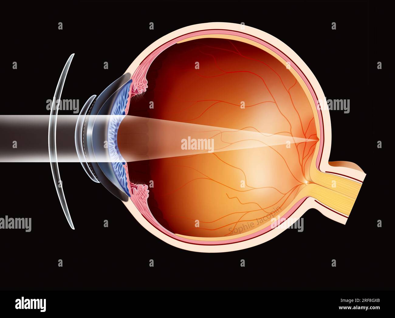 Aphakia hi-res stock photography and images - Alamy