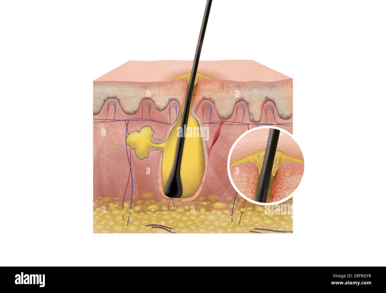2D skin section with pimple with epidermis, dermis and hypodermis ...
