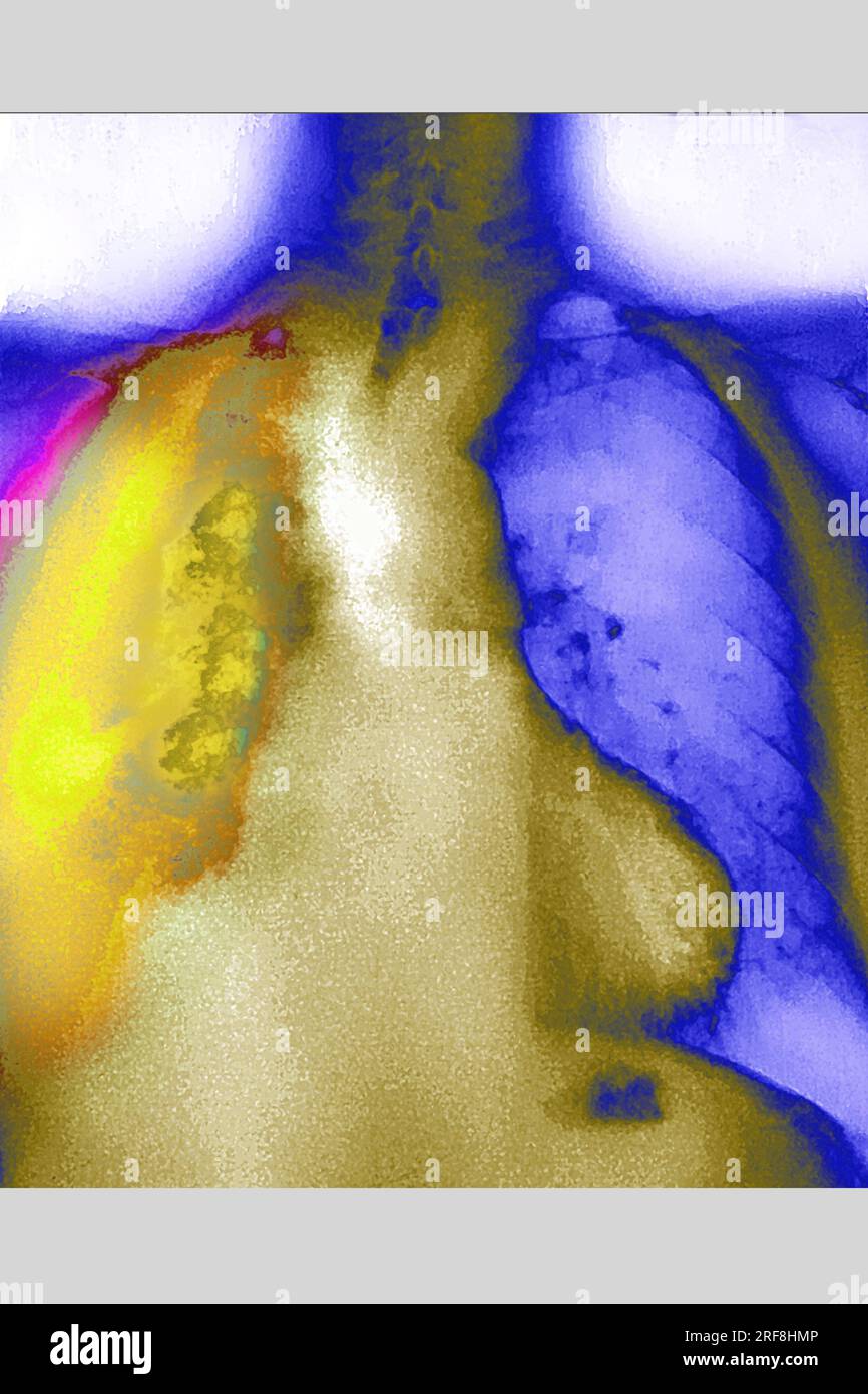 Chest radiography lung cancer hi-res stock photography and images - Alamy
