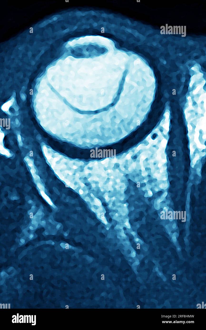 Retinal detachment of the left eye, visualized by radial section MRI ...