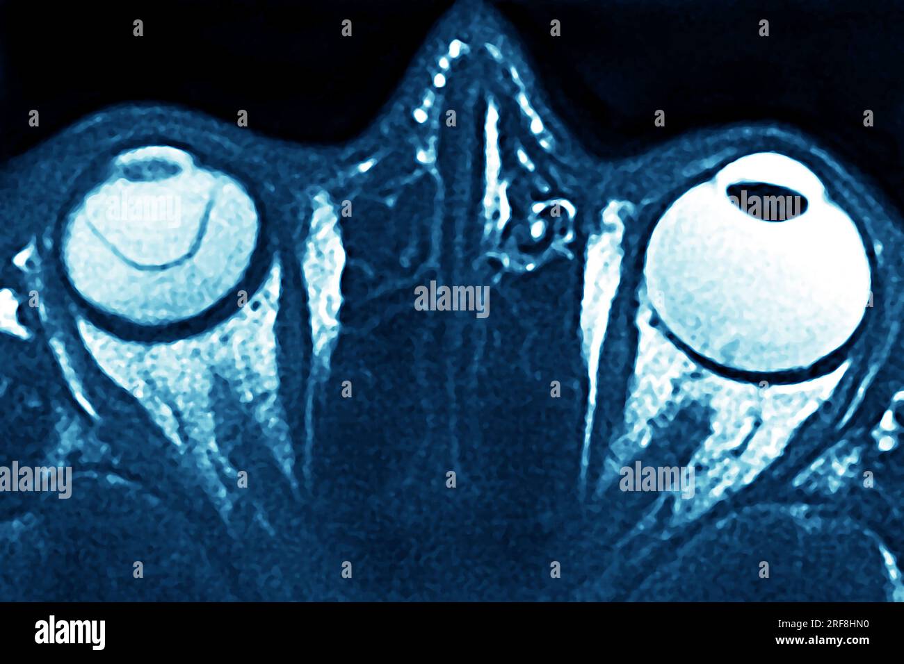 Retinal detachment of the left eye, visualized by radial section MRI ...
