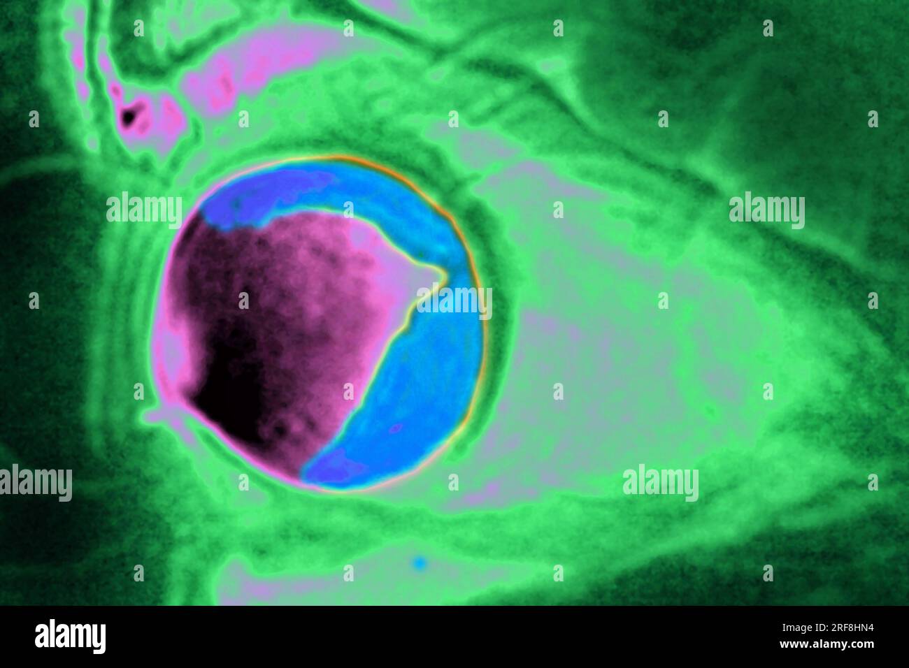 Retinal detachment of the left eye, visualized by radial section MRI ...