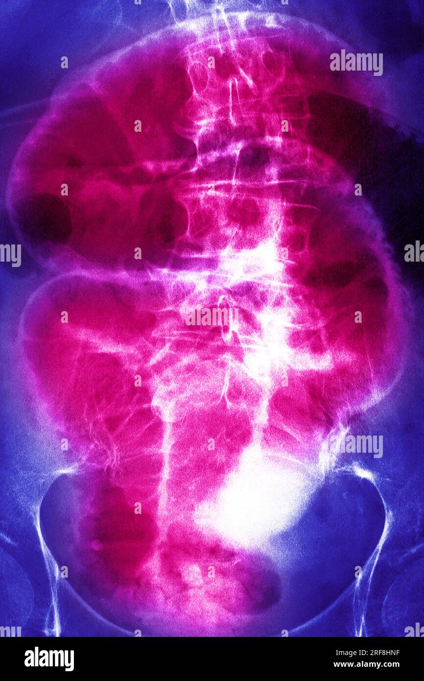Chronic colitis (inflammatory bowel disease), revealed by a frontal ...