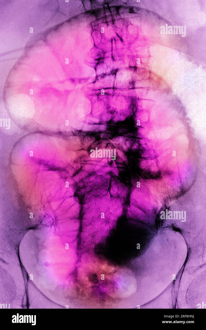 Chronic colitis (inflammatory bowel disease), revealed by a frontal ...
