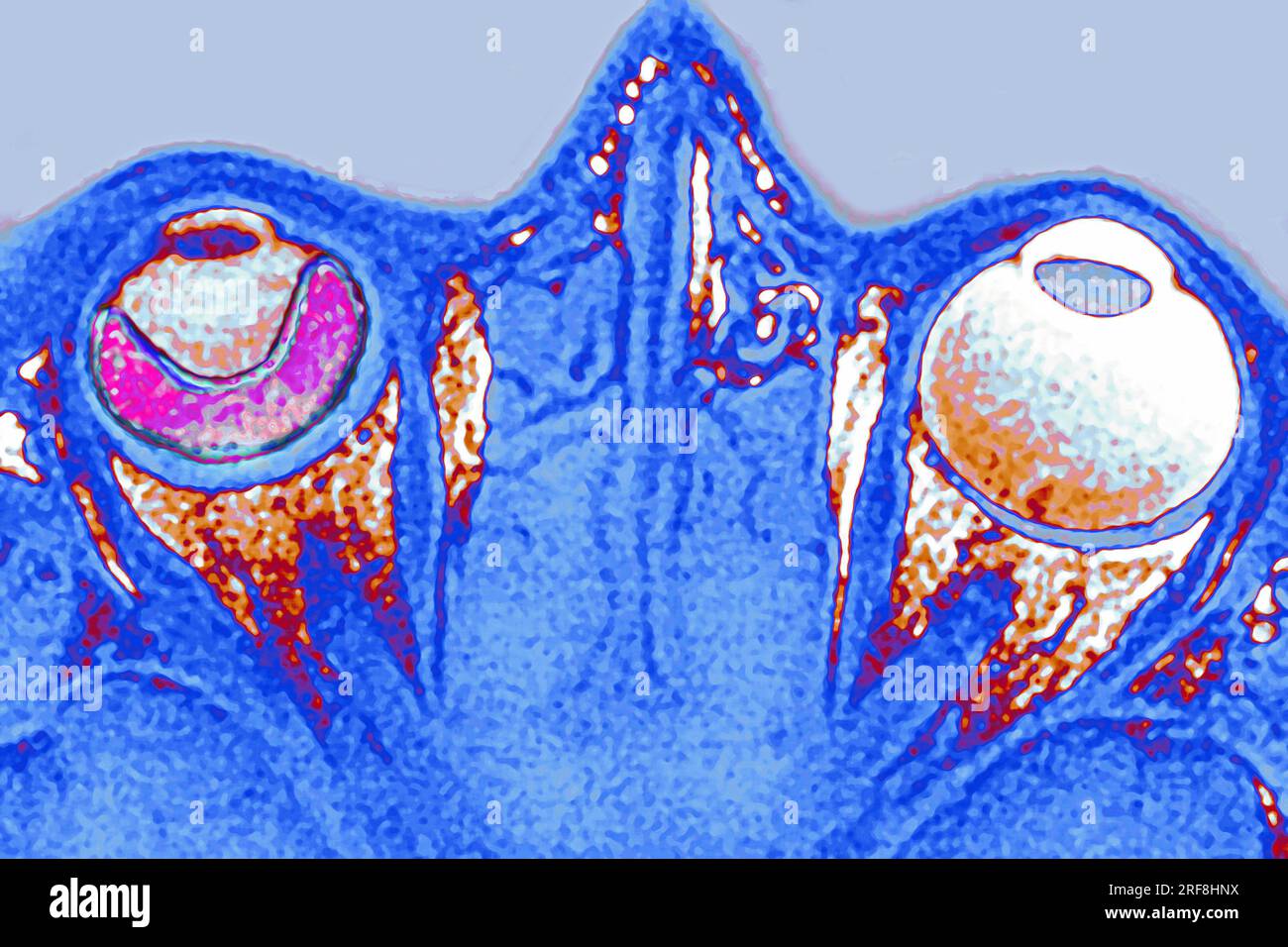 Retinal detachment of the left eye, visualized by radial section MRI ...