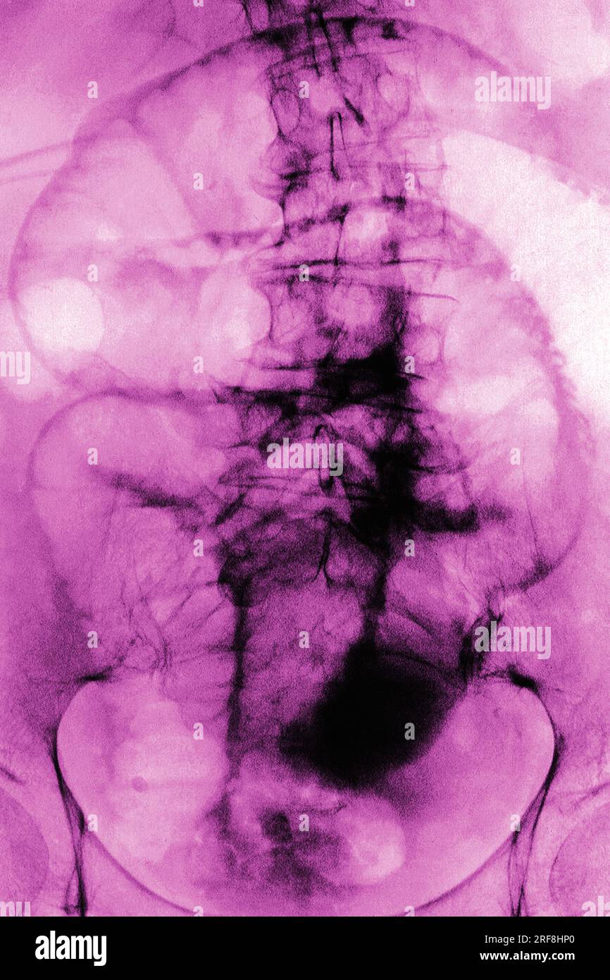Chronic colitis (inflammatory bowel disease), revealed by a frontal ...