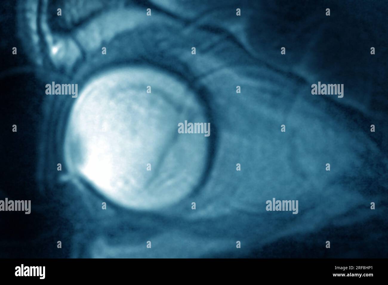 Retinal detachment of the left eye, visualized by radial section MRI ...