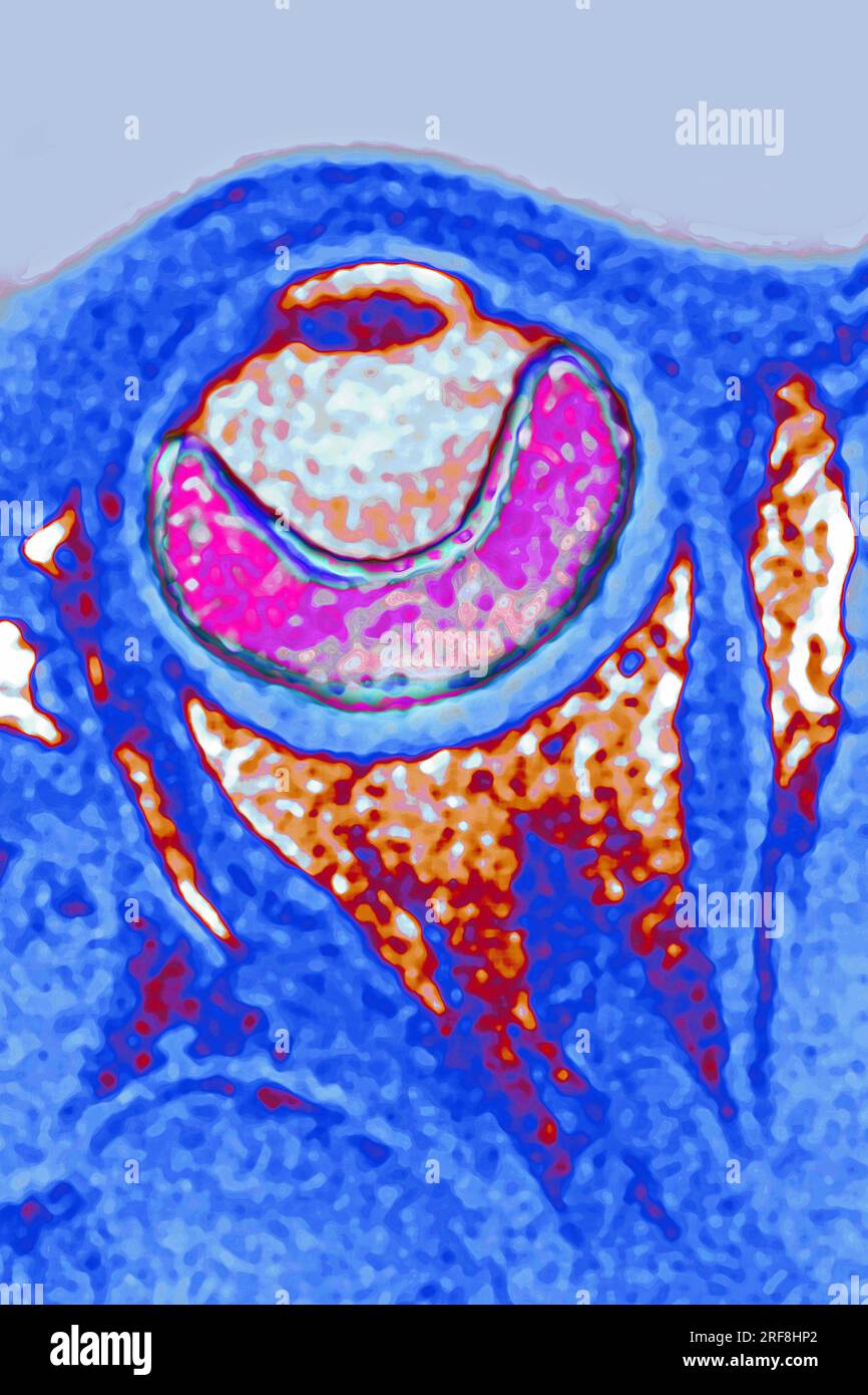 Retinal detachment of the left eye, visualized by radial section MRI ...