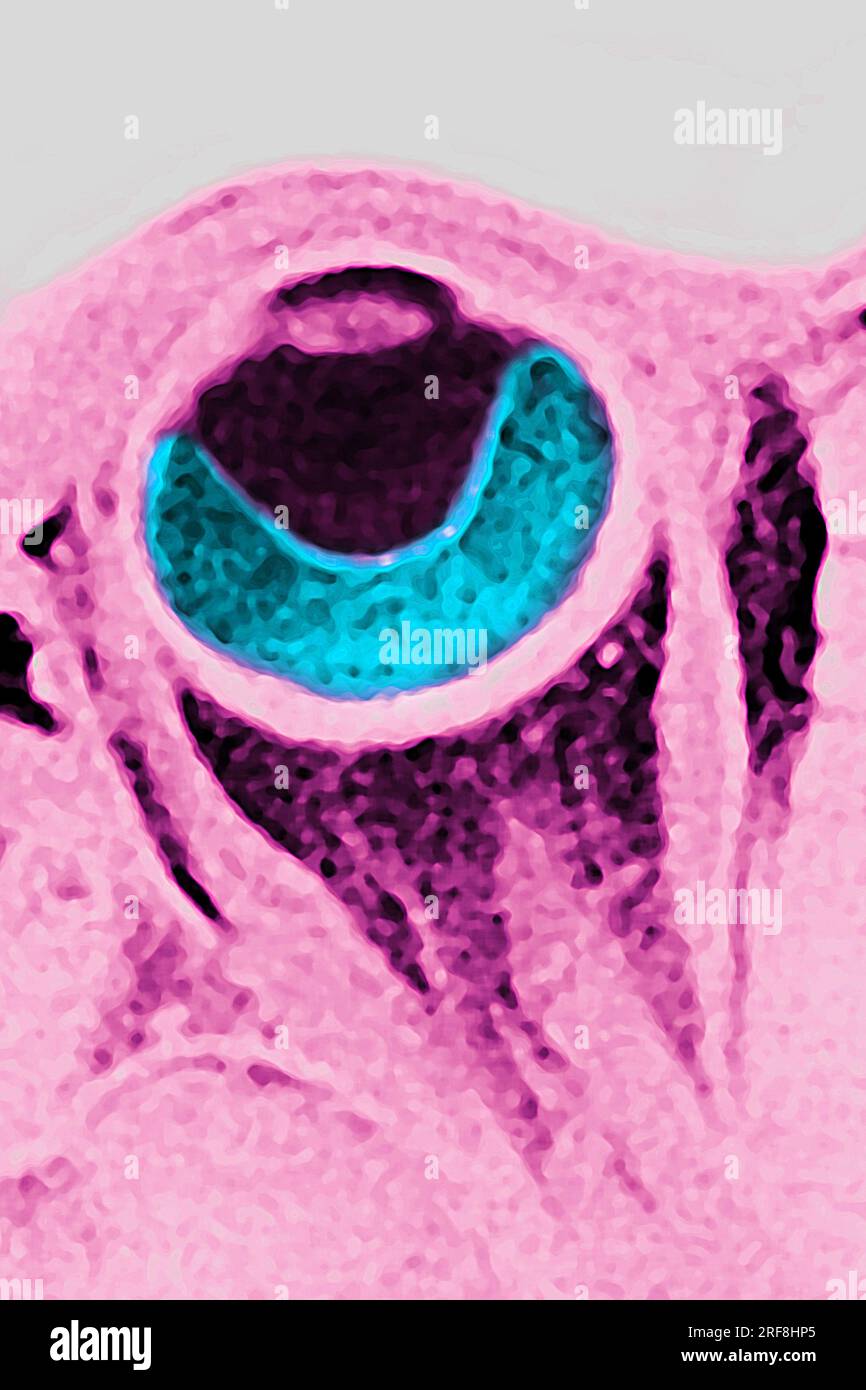 Retinal detachment of the left eye, visualized by radial section MRI ...