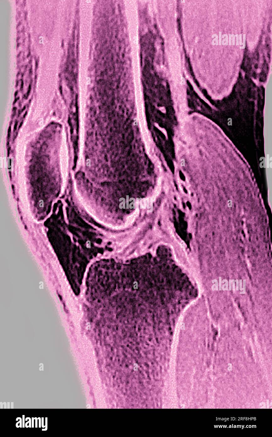 Normal knee visualized by MRI in sagittal section Stock Photo - Alamy