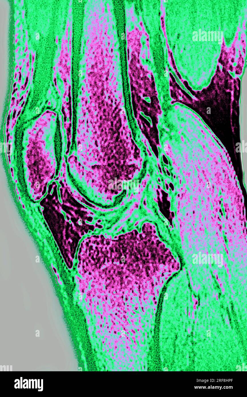 Normal knee visualized by MRI in sagittal section Stock Photo - Alamy