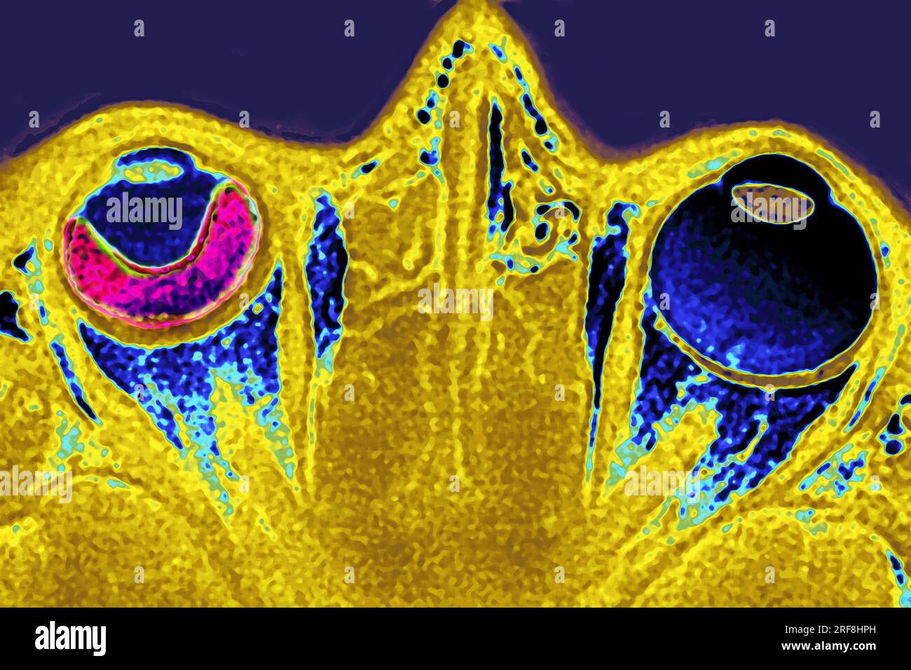Retinal detachment of the left eye, visualized by radial section MRI ...