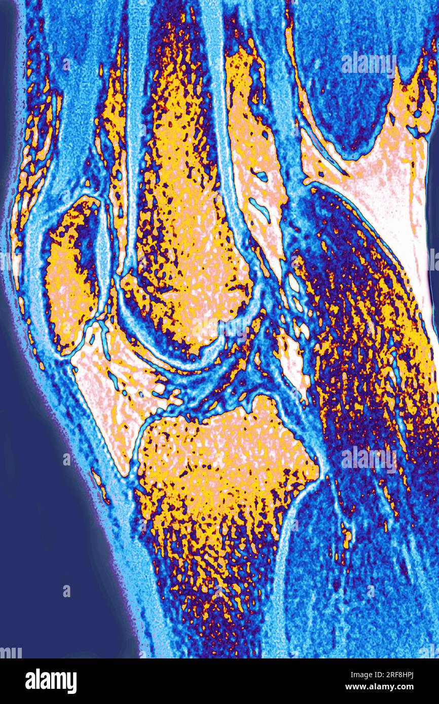 Normal knee visualized by MRI in sagittal section Stock Photo - Alamy