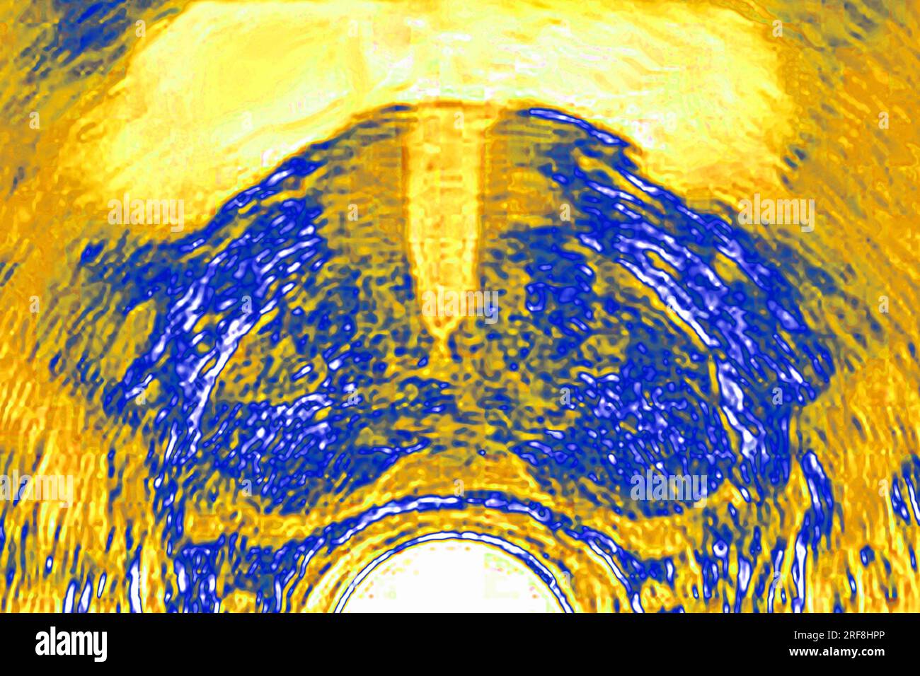 Prostate (healthy prostate gland), visualized in ultrasound in frontal ...