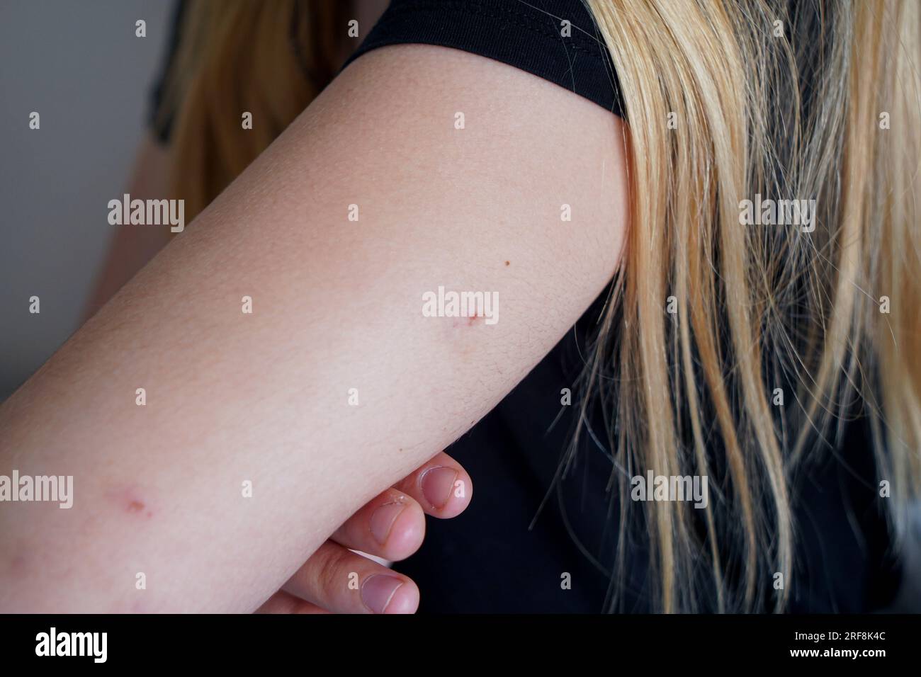 Trace of a needle prick on the arm of a patient, in the emergency room ...