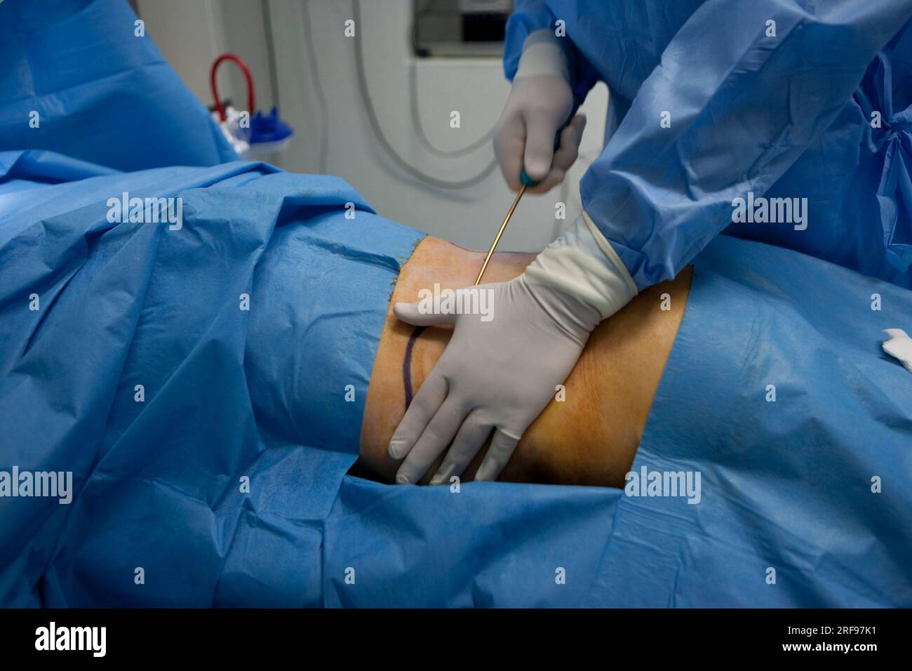 Vacuum aspiration hi-res stock photography and images - Alamy