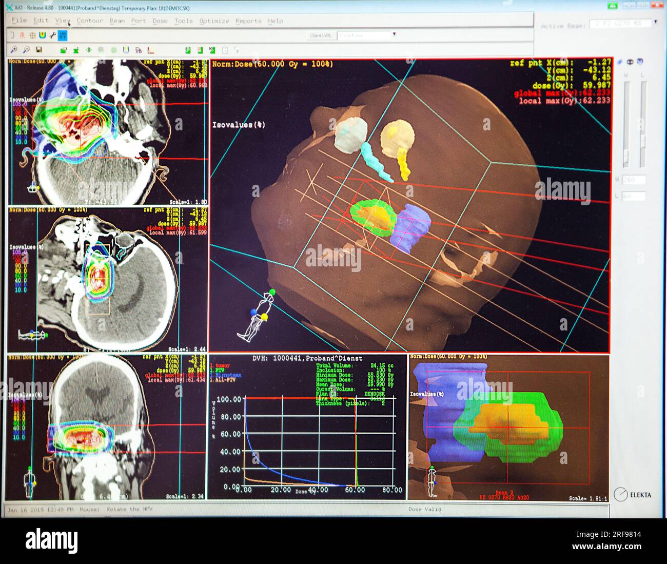 Proton therapy irradiates cancer cells with a beam of protons in the ...