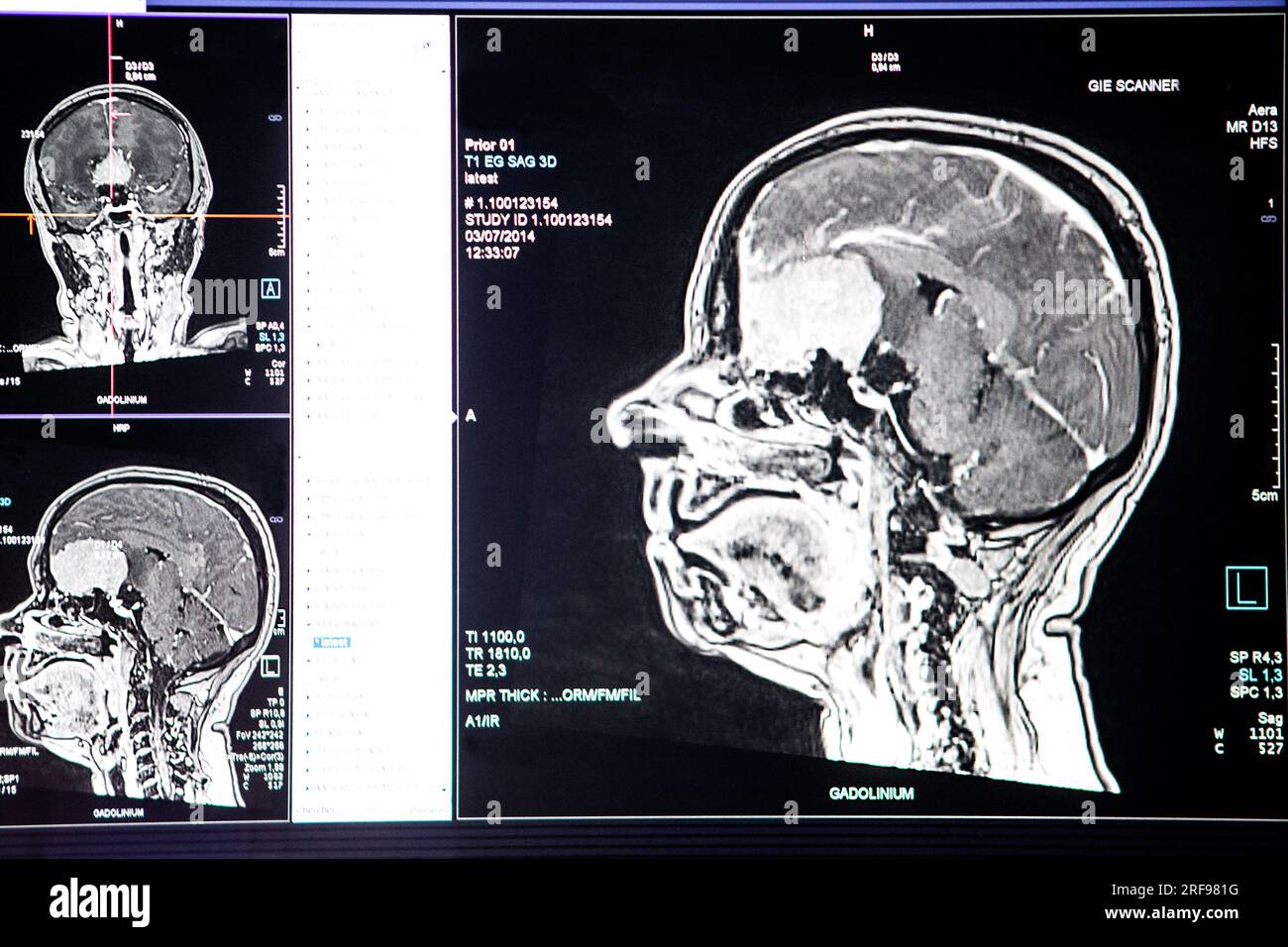 Brain images obtained by MRI in a radiology department of a hospital ...