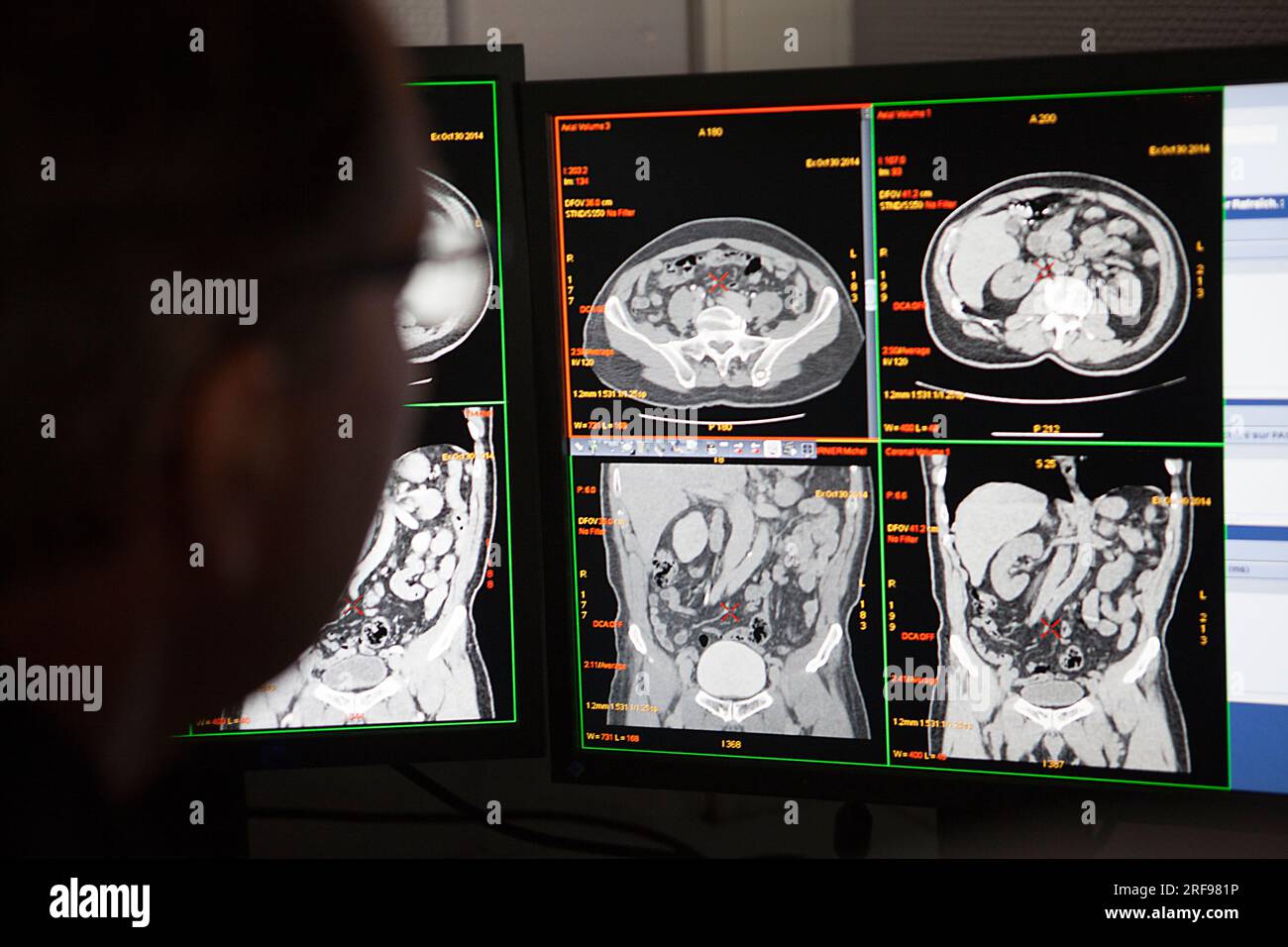 Doctor analyzing ct scan on hi-res stock photography and images - Alamy