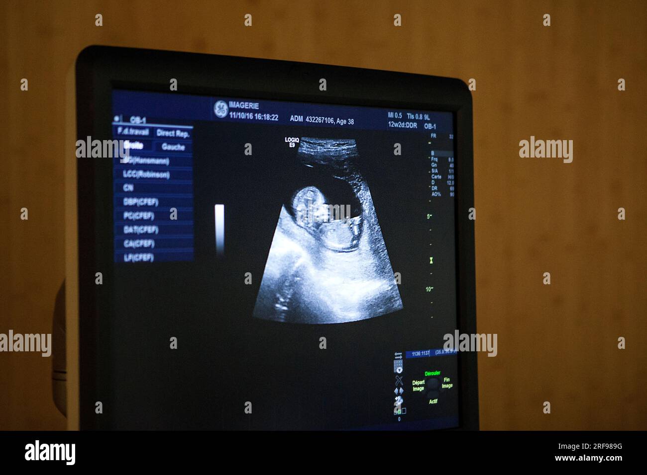 Fetal ultrasound of the 1st trimester of the fetus, in a radiology ...