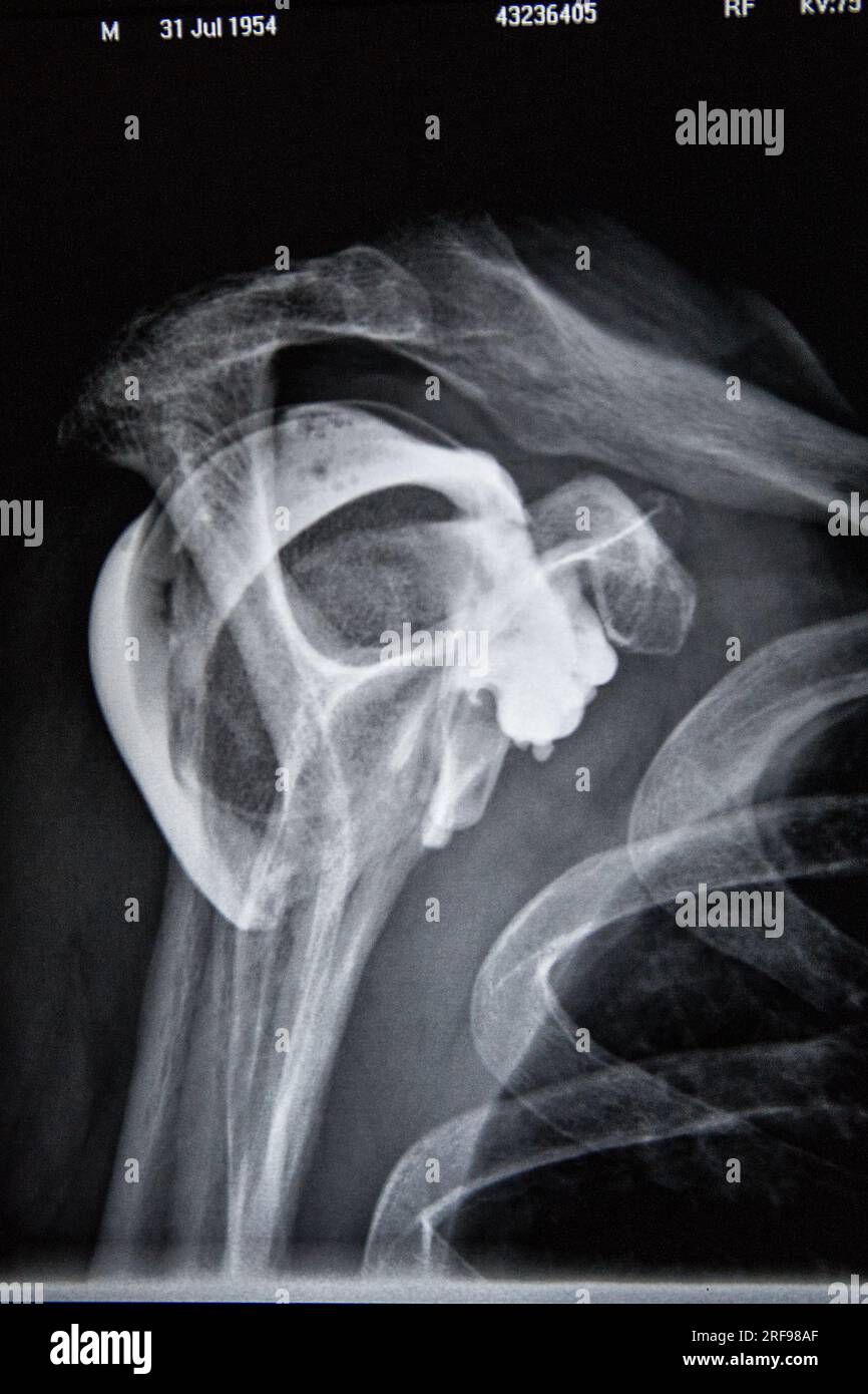 Arthrography hi-res stock photography and images - Alamy