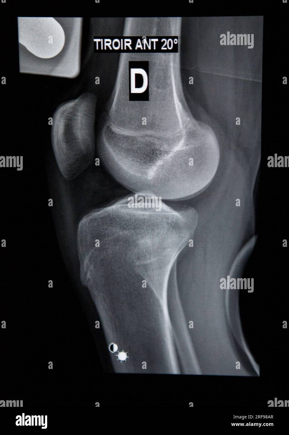 In a radiology center, Telos dynamic radiography of a knee, following a ...