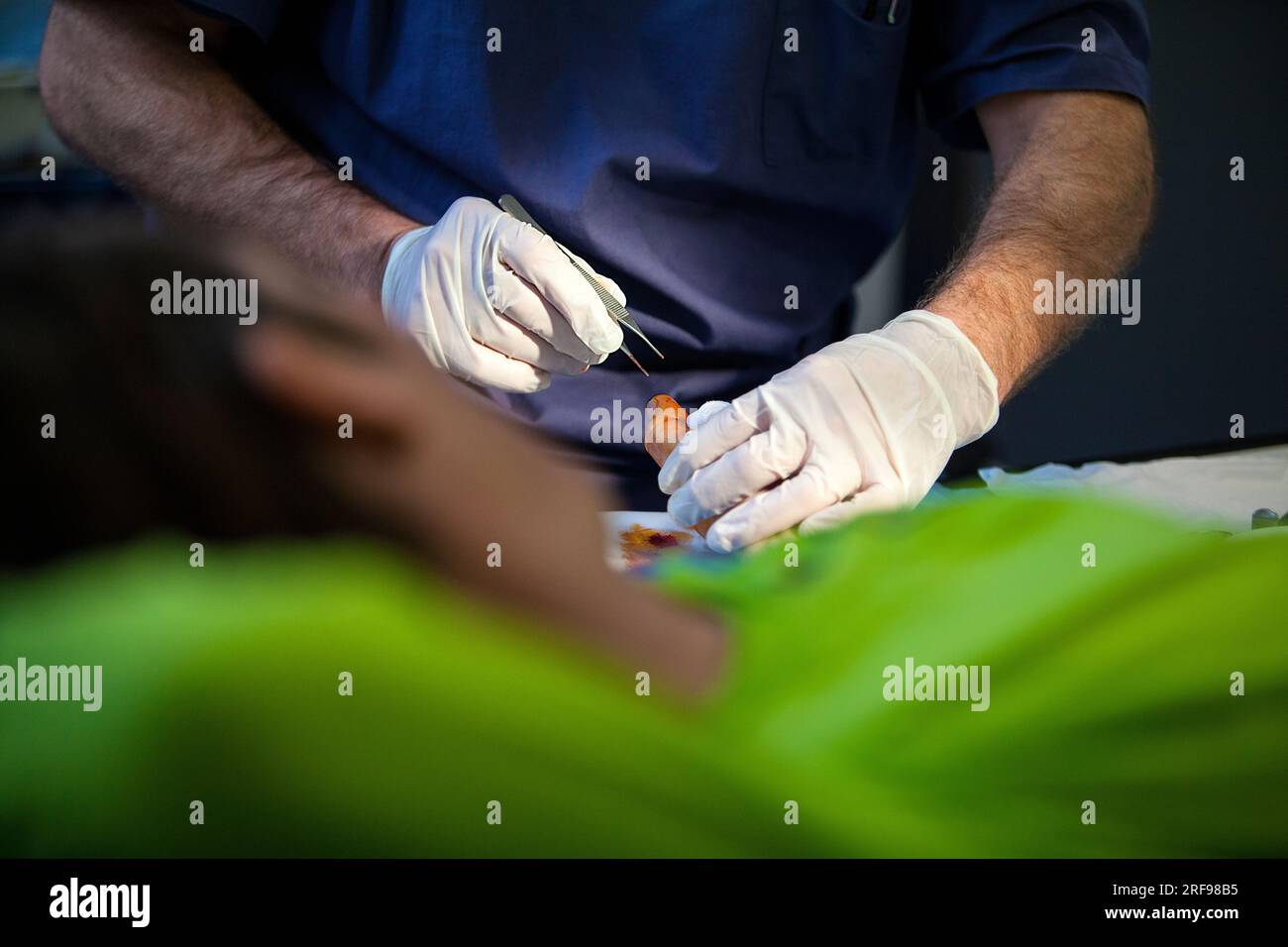 Thumb dislocation hi-res stock photography and images - Alamy