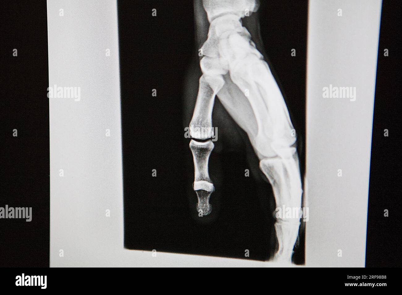 Hand bone dislocation hi-res stock photography and images - Alamy