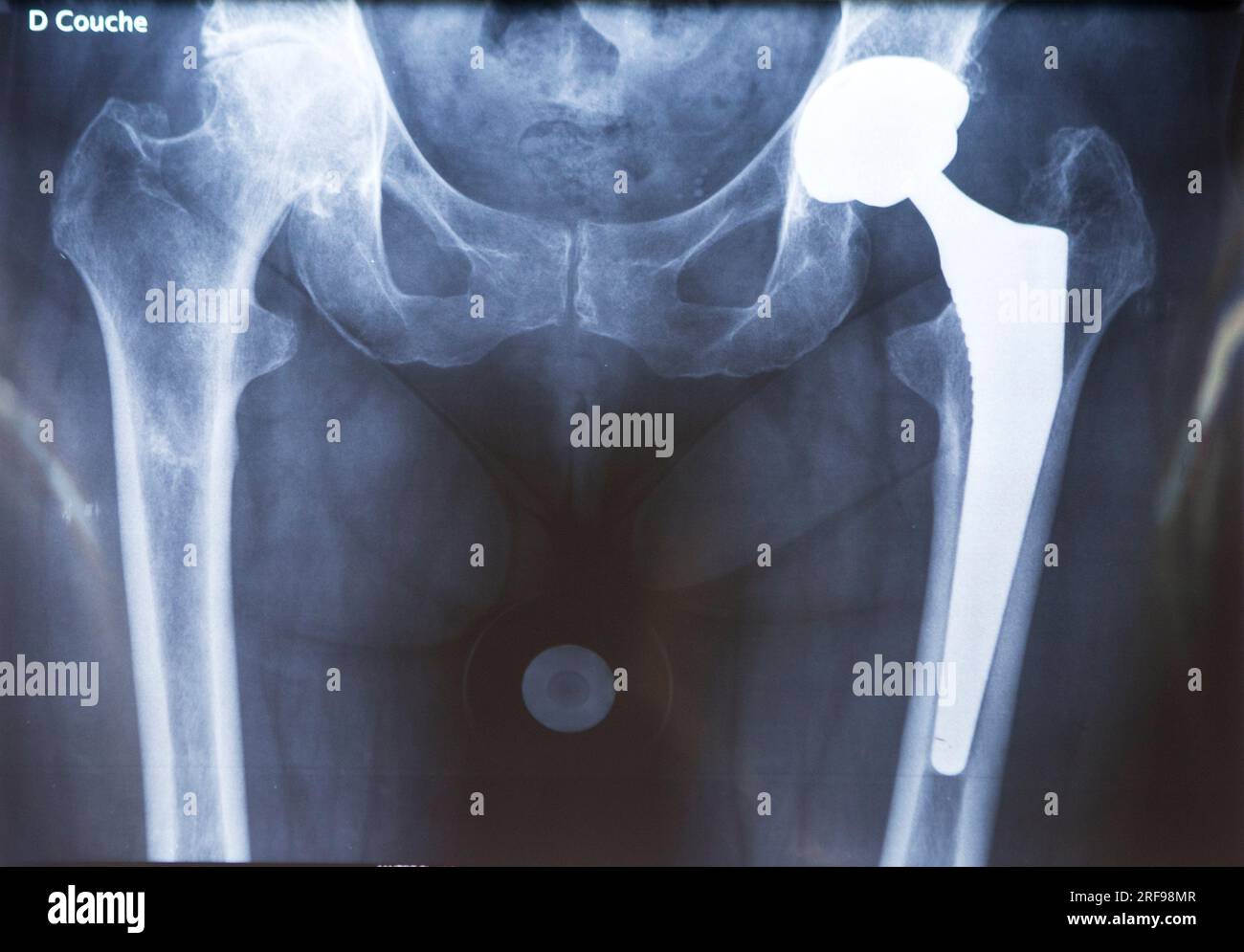 X-ray of a hip prosthesis Stock Photo - Alamy