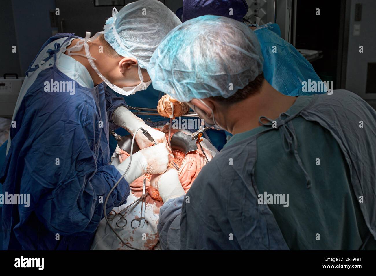 Top view of surgeons team during complex operation on open cavity of ...