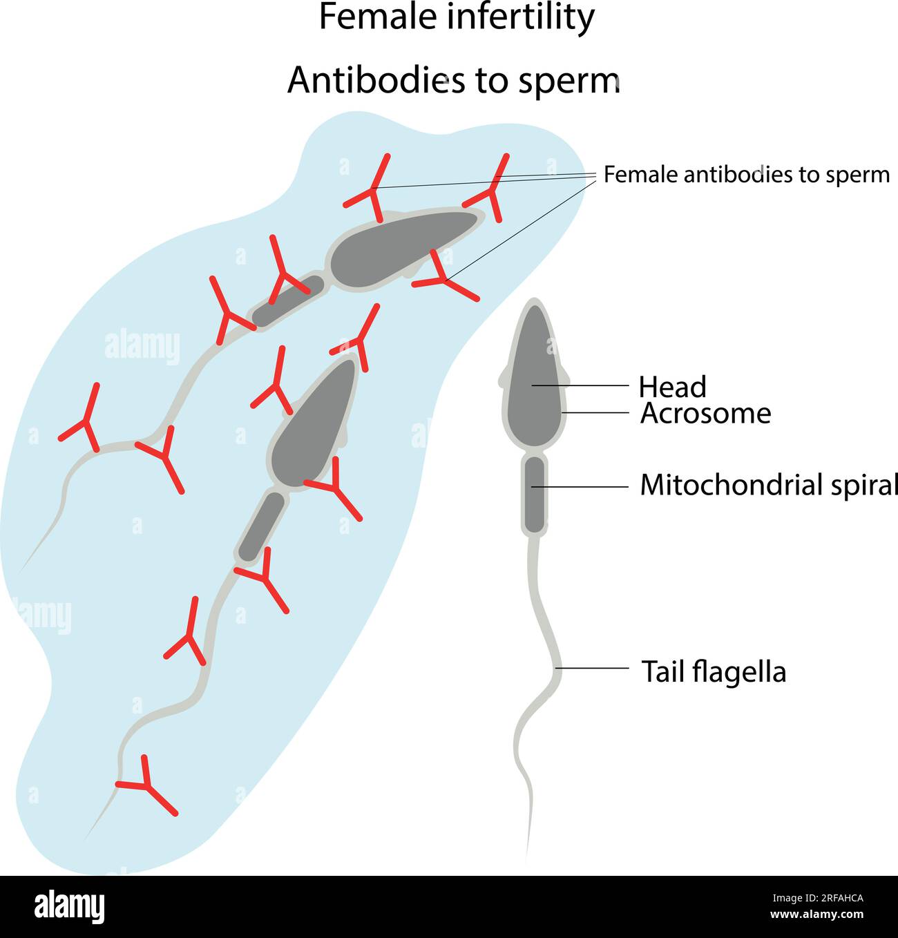Female infertility. The structure of the sperm Stock Vector Image & Art ...