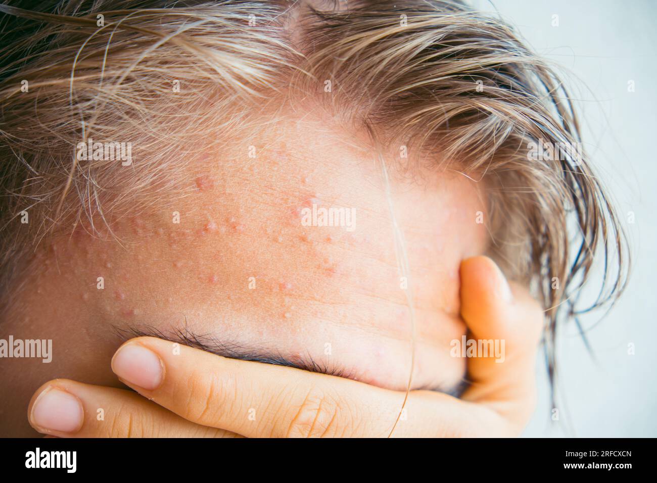 Acne on teenage boy forehead. Child is upset because of skin problems ...