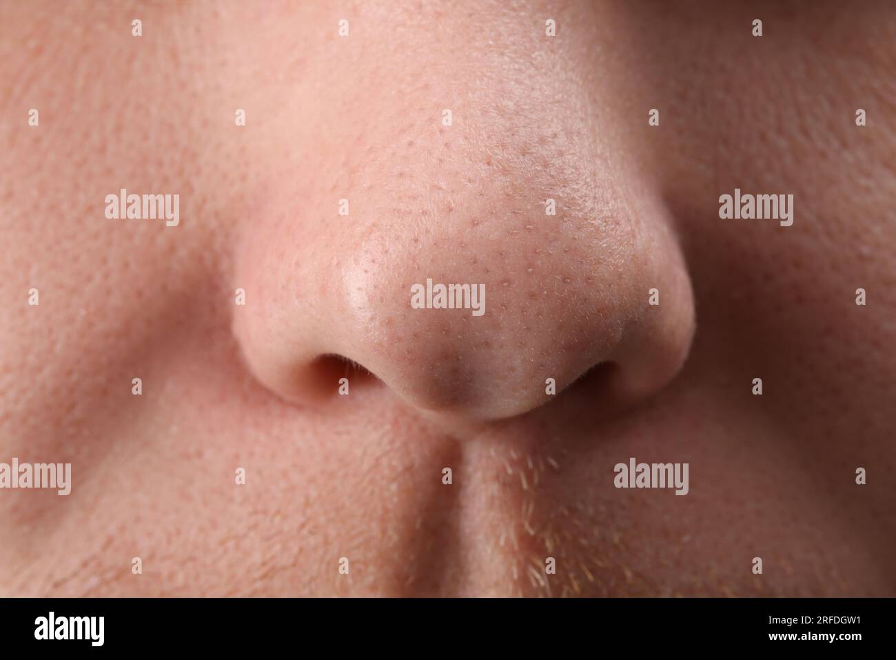 Young man with acne problem, closeup view of nose Stock Photo - Alamy