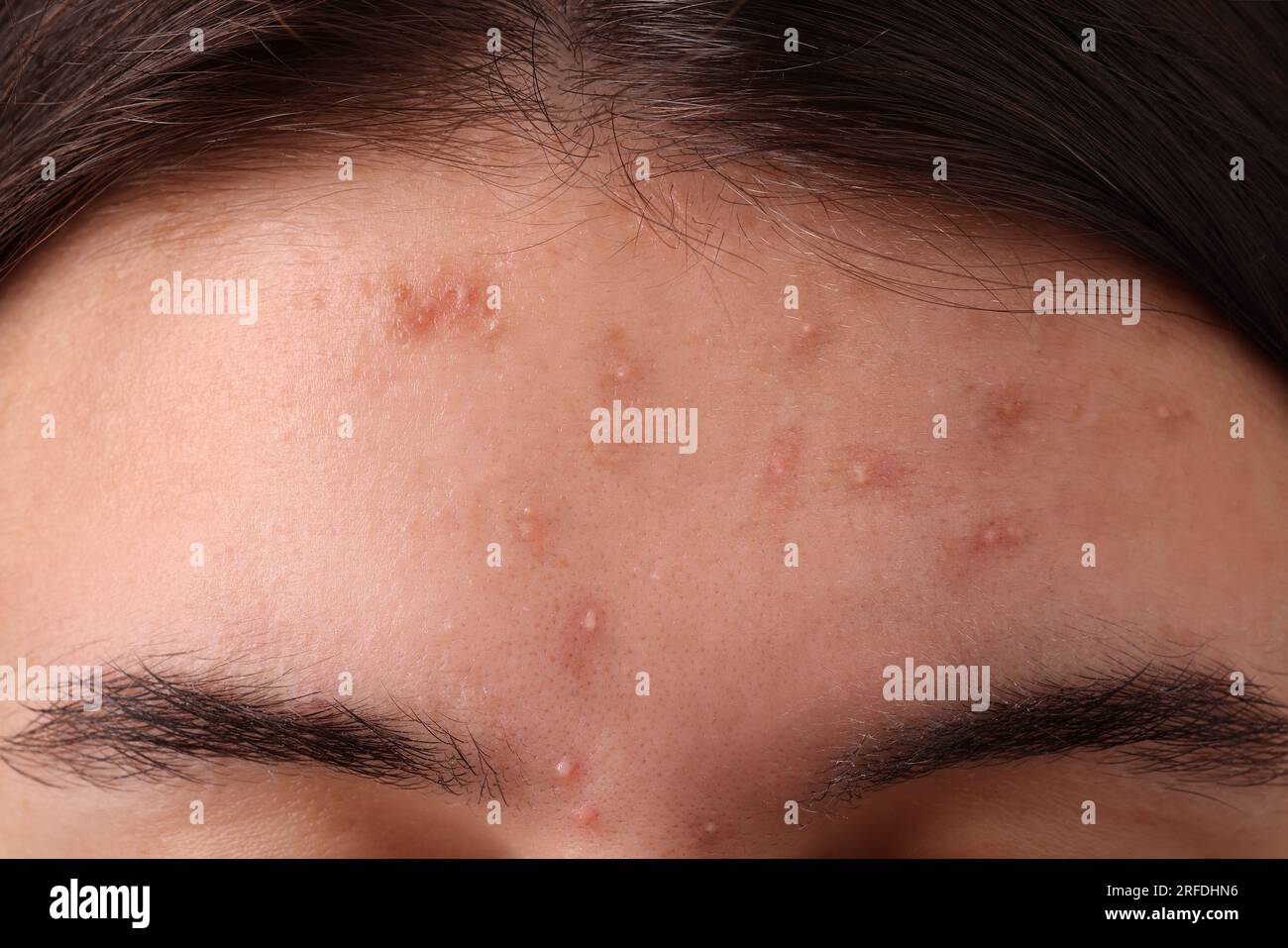 Acne problem hi-res stock photography and images - Alamy