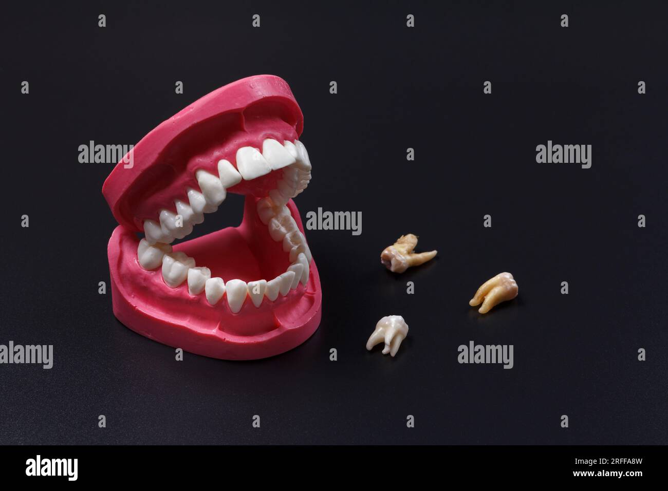 Layout of the human jaw and extracted sick teeth Stock Photo - Alamy