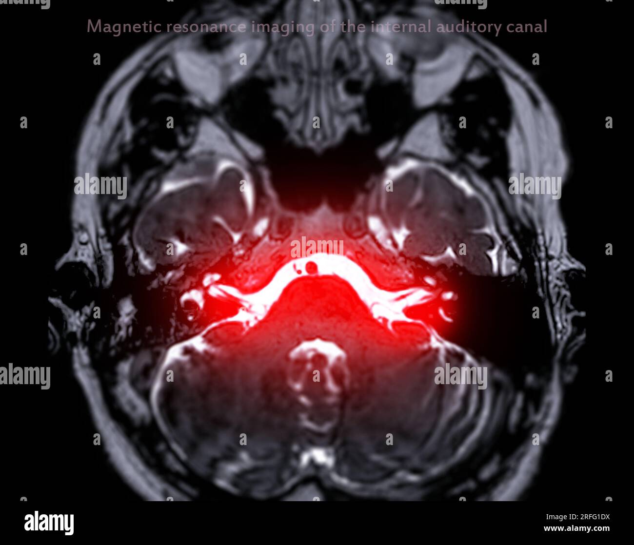 MRI Brain scan with the internal auditory canal (IAC) axial view Stock ...