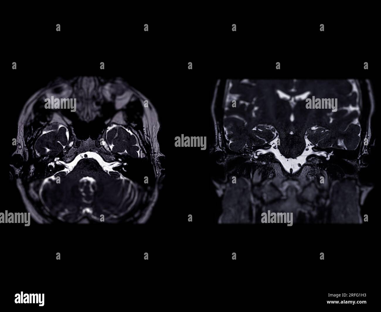 MRI Brain scan with the internal auditory canal (IAC) axial and Coronal ...