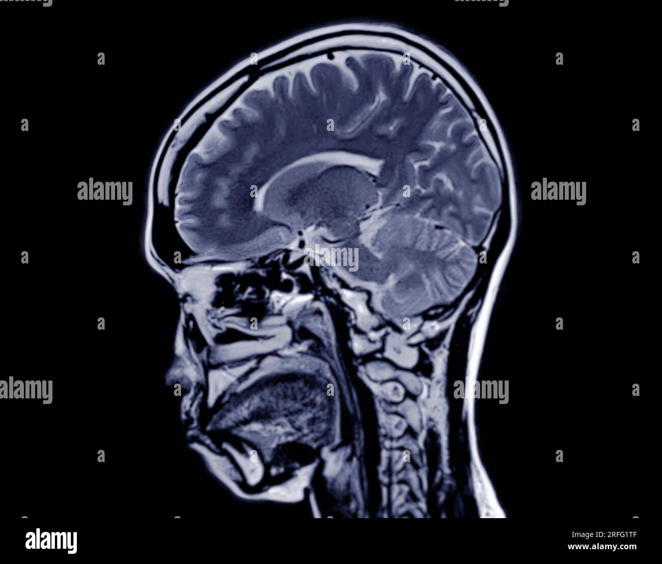 MRI brain scan sagittal plane for detect Brain diseases sush as stroke ...