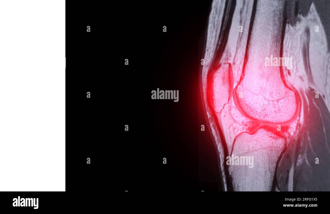 Magnetic resonance imaging or MRI of knee joint sagittal PDW for detect ...