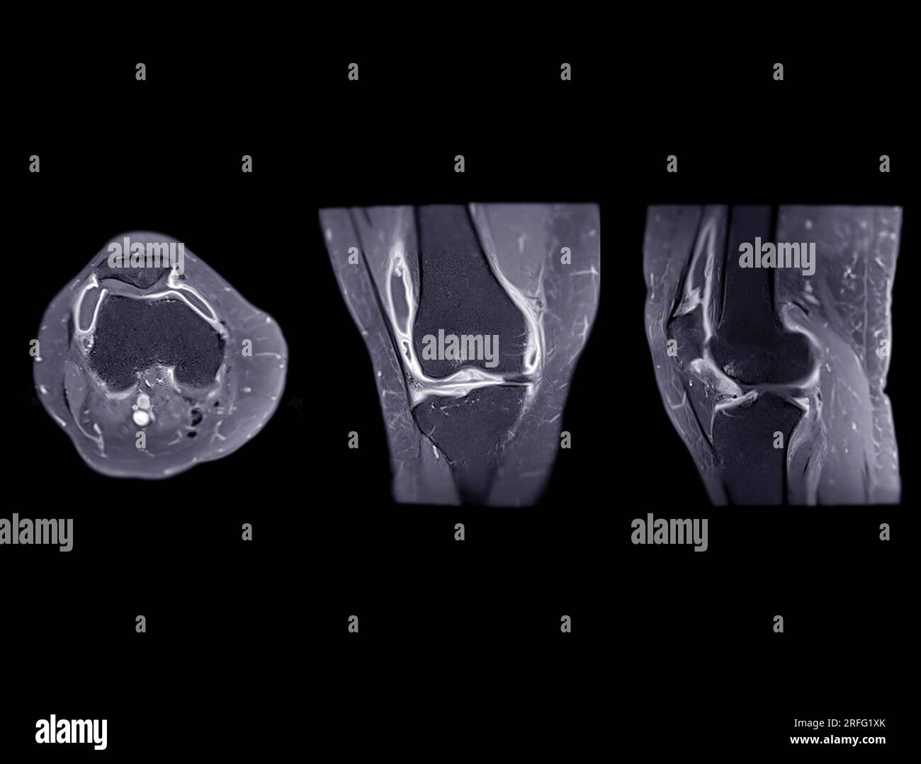 Magnetic resonance imaging or MRI of knee joint Axial ,Coronal and ...