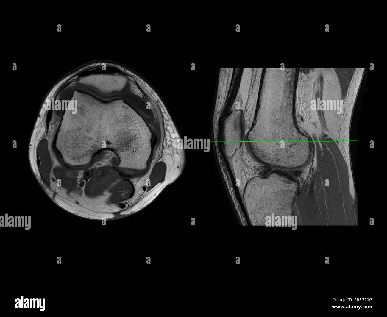 Magnetic resonance imaging or MRI of knee joint Axial and sagittal PDW for detect tear or sprain ...
