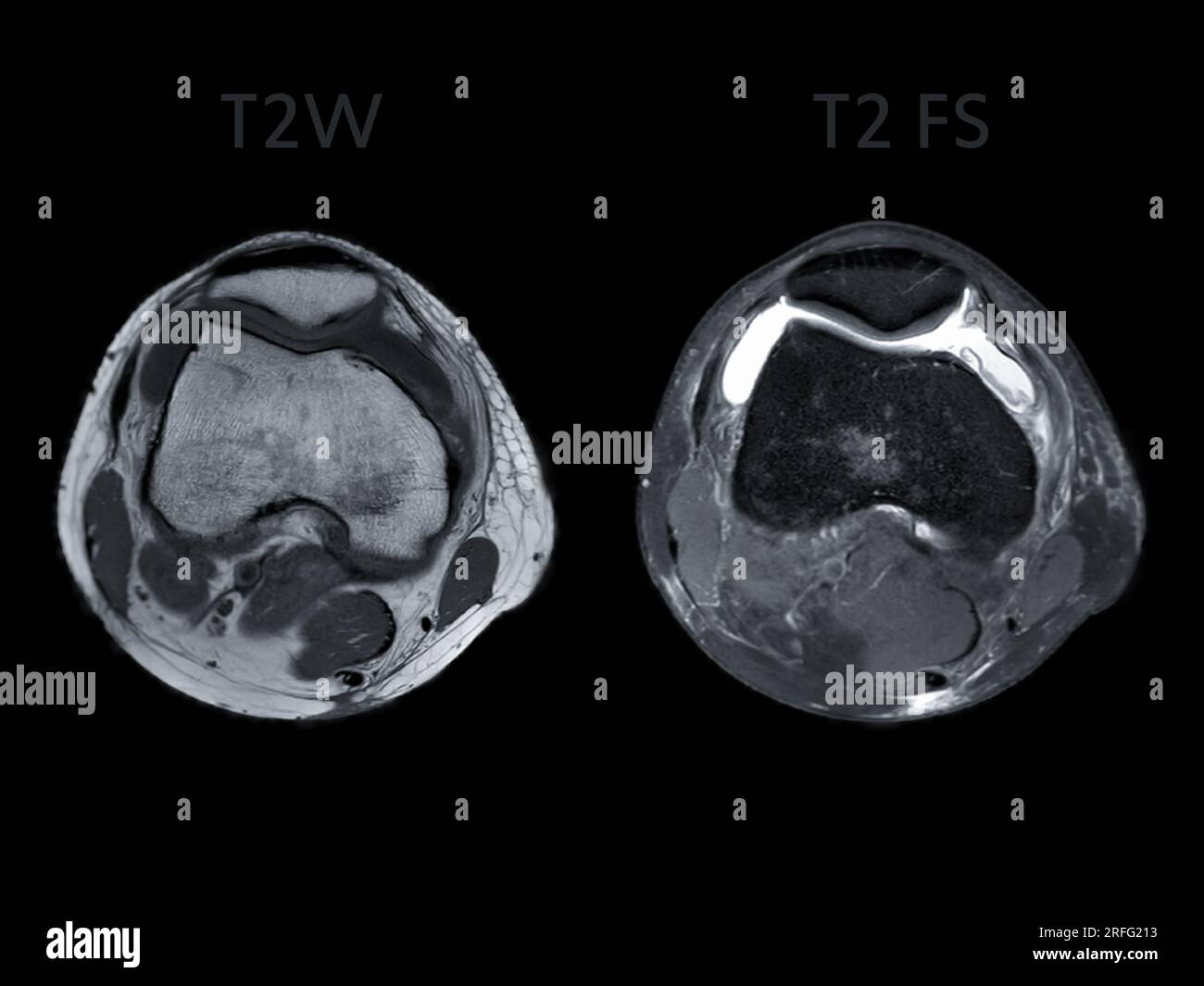 Magnetic Resonance Imaging Or Mri Of Knee Joint Axial View T2 And T2 Fs For Detect Tear Or