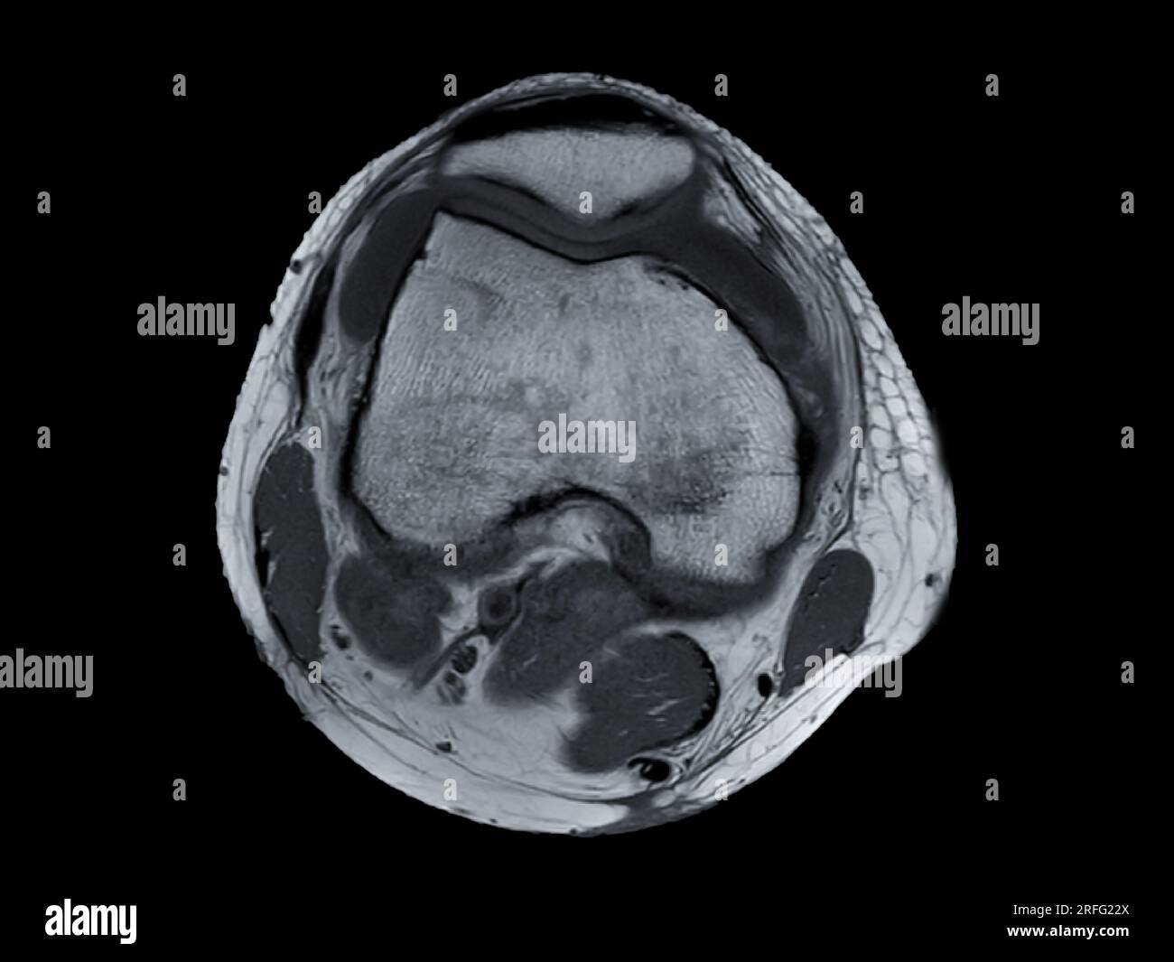 Mri Knee Axial Mri Knee Joint Magnetic Resonance Imaging