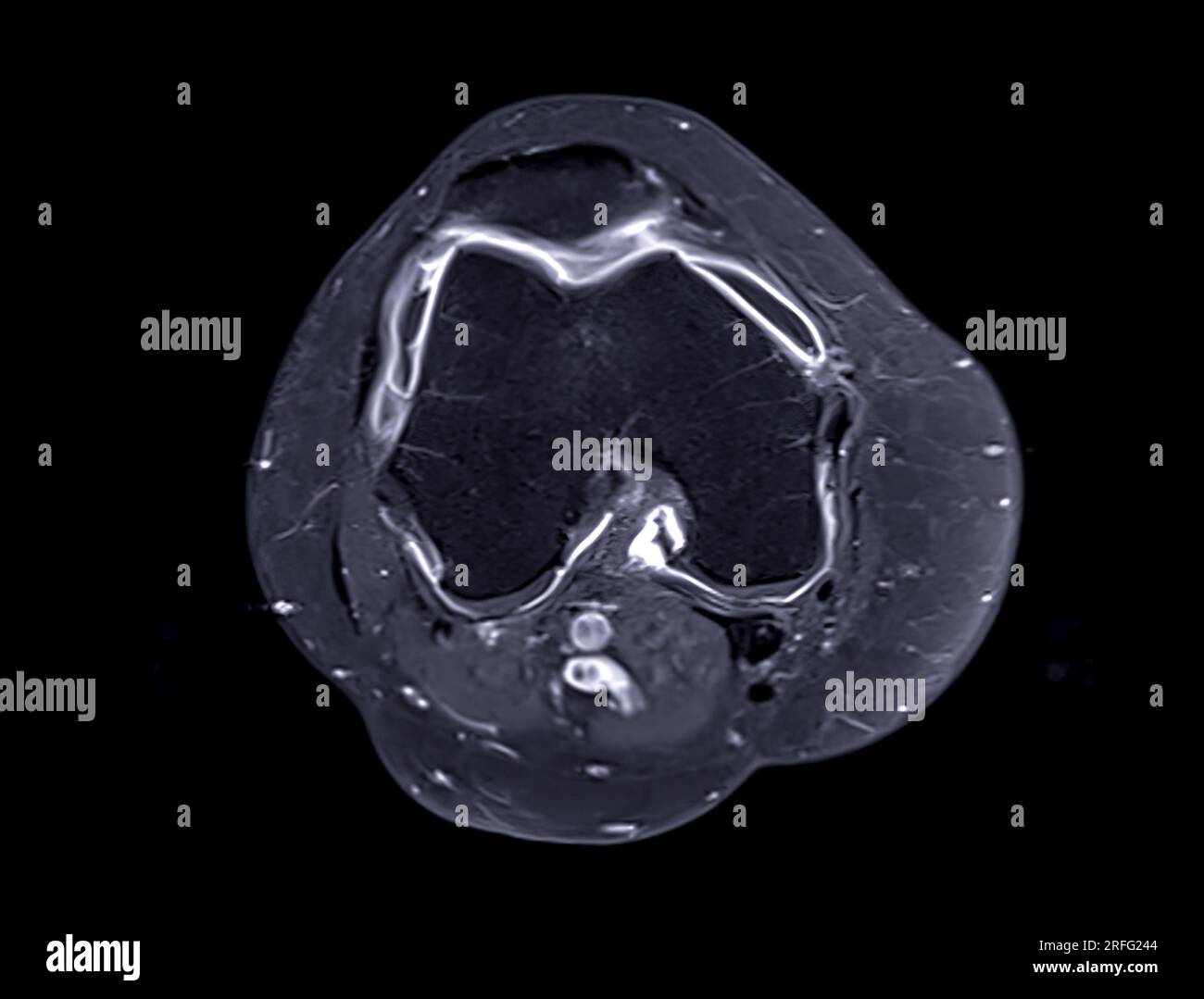 Magnetic resonance imaging or MRI of knee joint Axial view T2 FS with ...