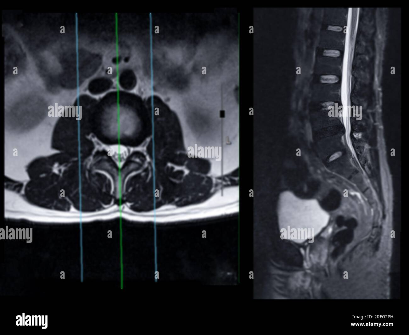 MRI L-S spine or lumbar spine Axial T2W view with sagittal plane for ...
